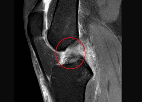 ACL Injury | ACL Tear | ACL Rupture | Knee Specialist | Los Angeles ...